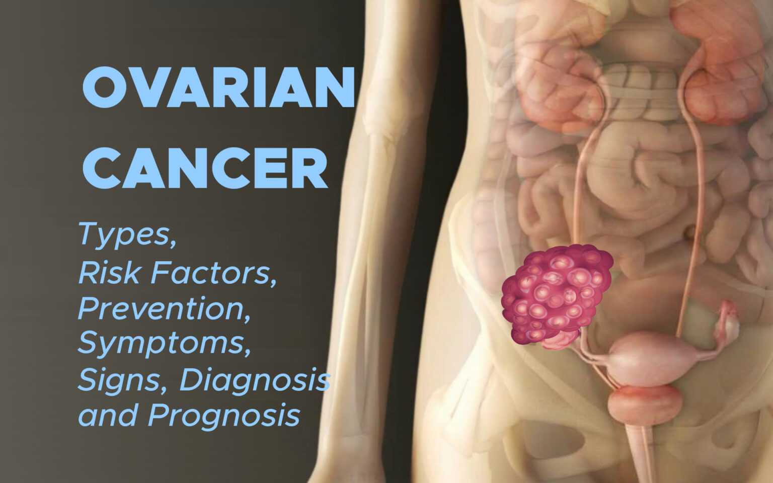 Ovarian Cancer: Types, Risk Factors, Prevention, Symptoms, Signs ...