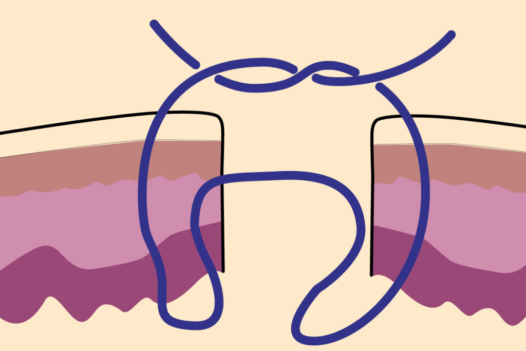 Common Suture Patterns - GynecolOncol