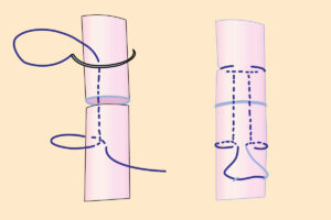 Common Suture Patterns - GynecolOncol