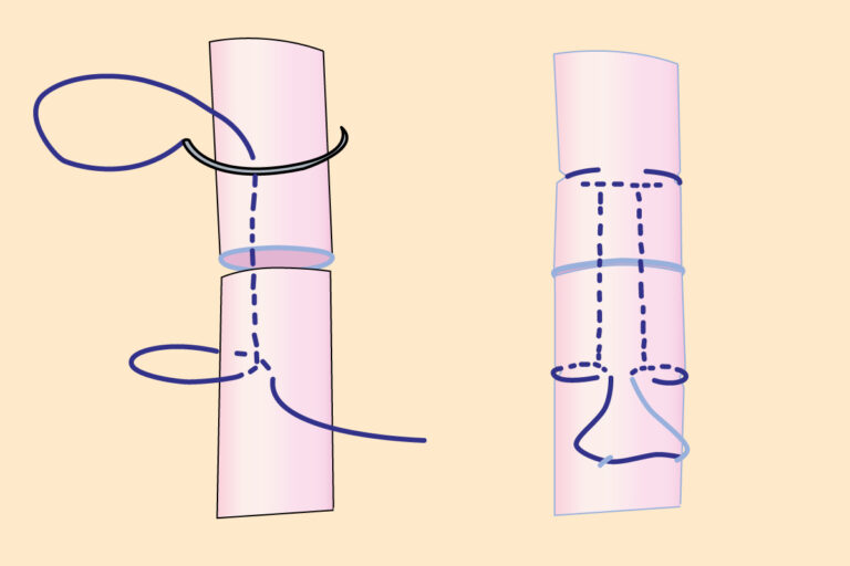 Common Suture Patterns - GynecolOncol