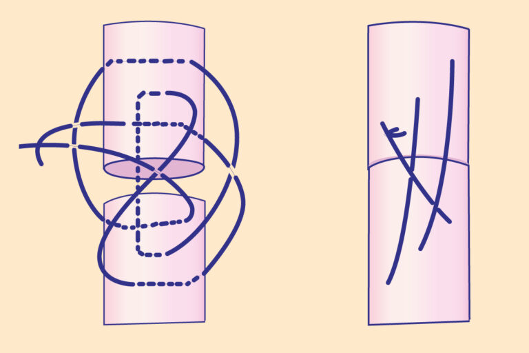 Common Suture Patterns - GynecolOncol